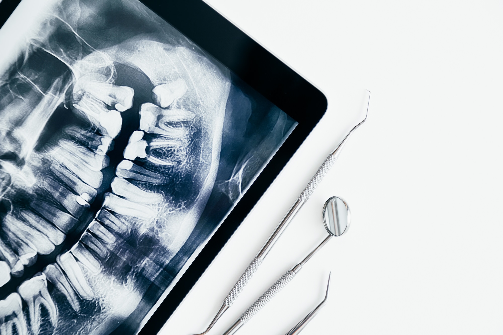 Qué es el prognatismo mandibular y cómo se corrige | DentalClaris